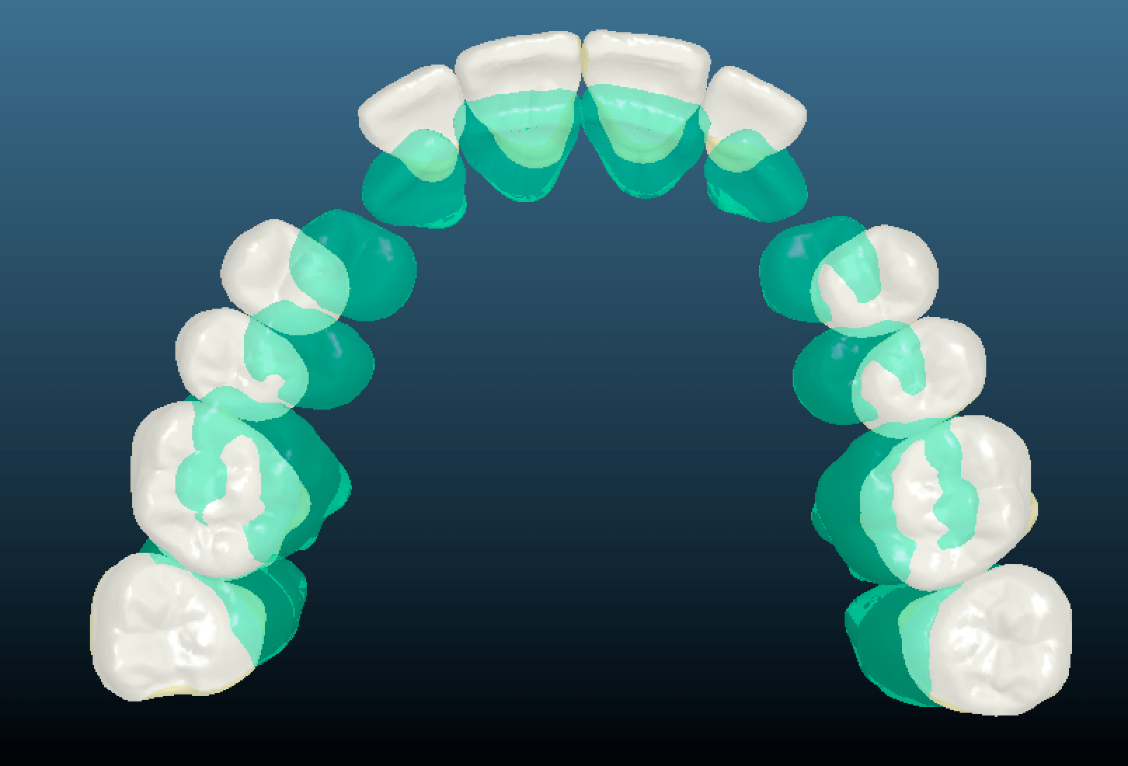 Case Study 20 - Narrow Smiles - Bandeen Orthodontics
