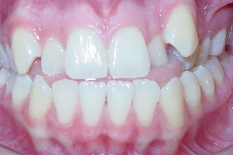 Class III - Bandeen Orthodontics