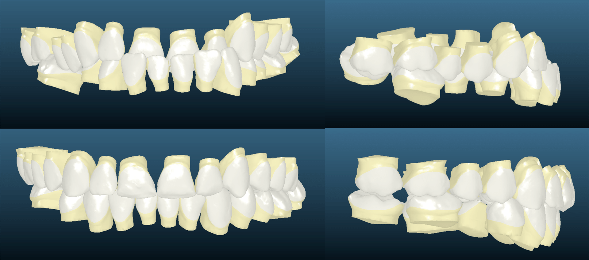 Case Study 10 - Orthodontic Class III - Bandeen Orthodontics