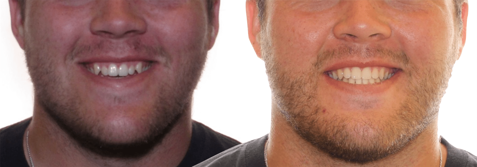 Case Study 9 - Orthodontic Class III - Bandeen Orthodontics