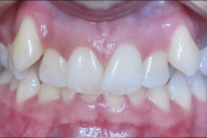 Class II - Bandeen Orthodontics